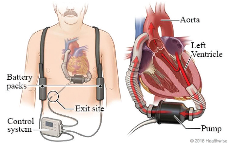 Heart & Lung Transplant Centre in Chennai, India - Ventricular Assist ...